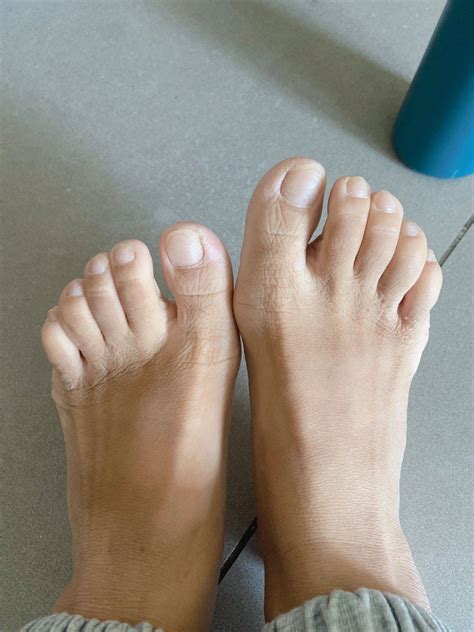 灰指甲又难看又难除？过来人分享祛灰秘籍，简单去除灰甲！ 哔哩哔哩