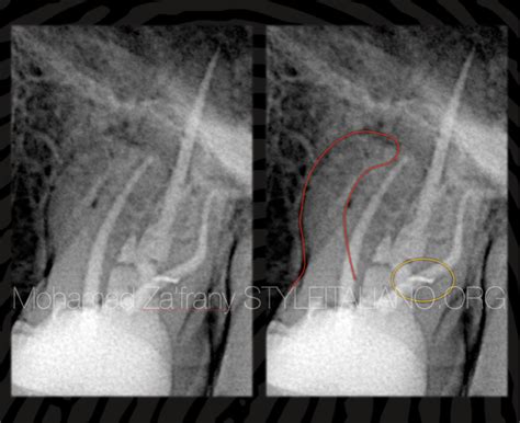 Failed Root Canals On X Rays What To Do 1311 Jackson Ave Dental Dentist In Long Island