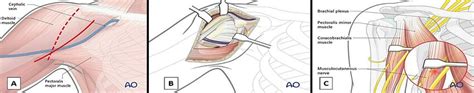 A And B The Deltopectoral Approach Utilizes The Deltoid And Pectoralis