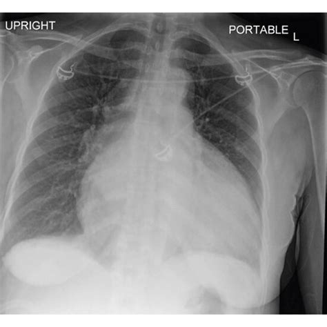 Upright Ap Cxr Obtained On Admission Shows Markedly Enlarged Cardiac