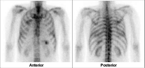 Figure 2 From Diffuse Pulmonary Ossification Developing In Patients