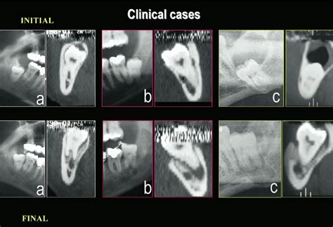 Clinical Cases Panoramic Radiograph And Ct Scan Of Deep Vertically Download Scientific Diagram