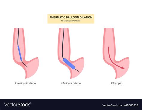 Endoscopic Pneumatic Dilation Royalty Free Vector Image