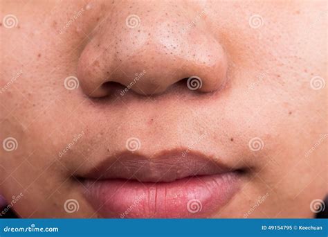 Espinillas De La Espinilla En La Nariz Y Los Labios Foto De Archivo