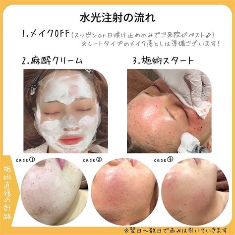 恵比寿フィラークリニックさんのインスタグラム写真 恵比寿フィラークリニックinstagram 「日焼けで後悔しない！ 日焼け前・後ケア☀