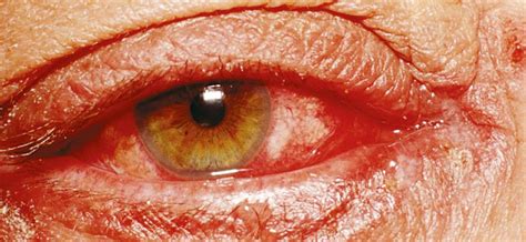 Conjunctivitis Pink Eye Clinical Tree