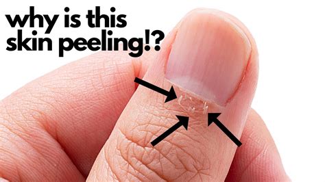 Skin Peeling After A Manicure Youtube