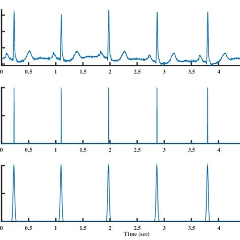 The Relabeling Of R Peak Annotations A Original ECG Signal B