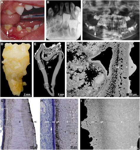 Clinical Radiographic And Microscopic Features Of Regional