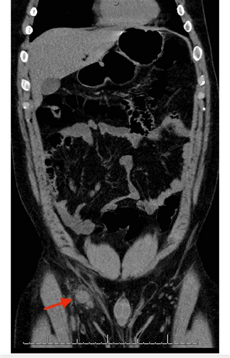 Ct Abdomen And Pelvis Sagittal View The Red Arrow Shows Right
