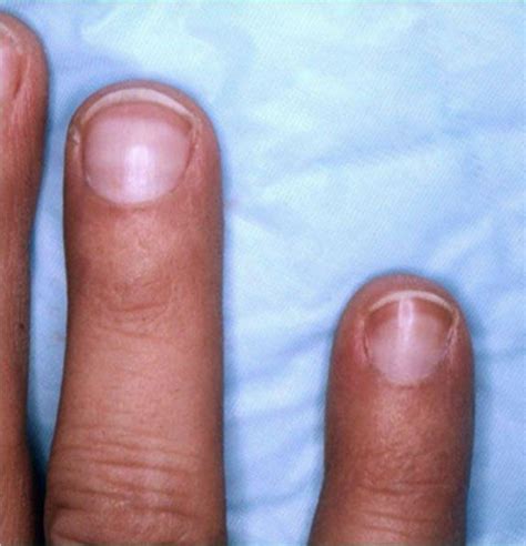 How Your Nails Warn You About Serious Health Conditions Fingernail