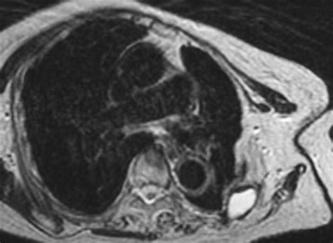 Scapulothoracic Bursitis Diagnosis At Greta Pickard Blog