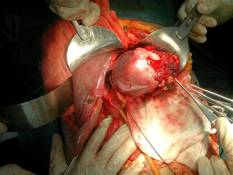 Modern Surgery Liver Cancer Surgery