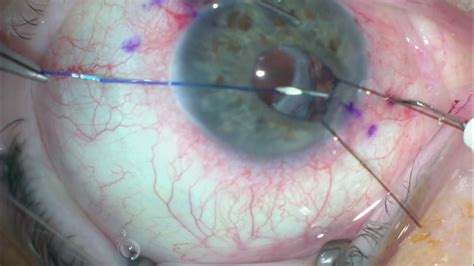 Belt Loop Scleral Fixation Technique In Ugh Syndrome Due To