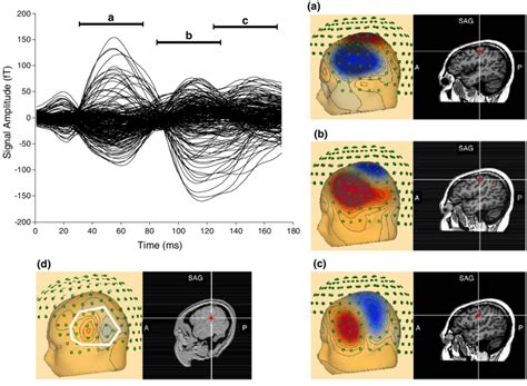 Dipole Source Localization Three Ecds Are Shown Based On A Single