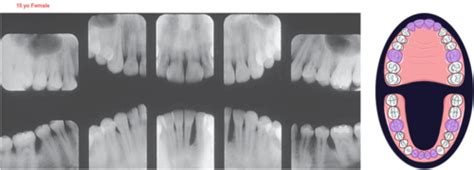 4 Aggressive And Atypical Forms Of Periodontitis Flashcards Quizlet
