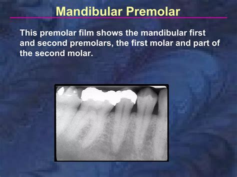 Radiology Paralleling Technique Pdf
