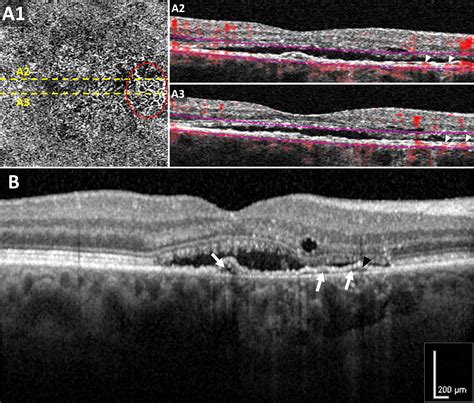 The Diagnostic Accuracy Of Double Layer Sign In Detection Of Macular Neovascularization