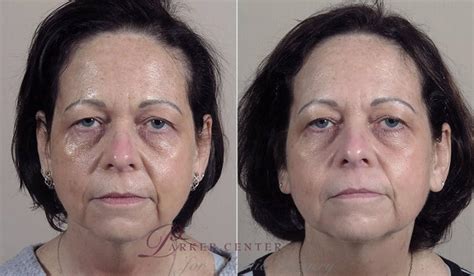 Nonsurgical Face Procedures Before And After Pictures Case 342