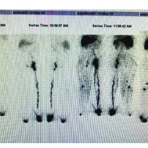 Lymphoscintigraphy Lack Of Superficial And Deep Lymphatics In The