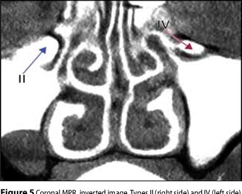 Figure 5 From Anatomic Patterns Of Maxillary Sinus Drainage Semantic Scholar