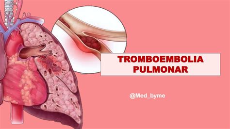 Tromboembolia Pulmonar Med Byme UDocz