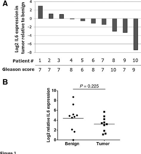 Figure 1 From A Paracrine Role For Il6 In Prostate Cancer Patients