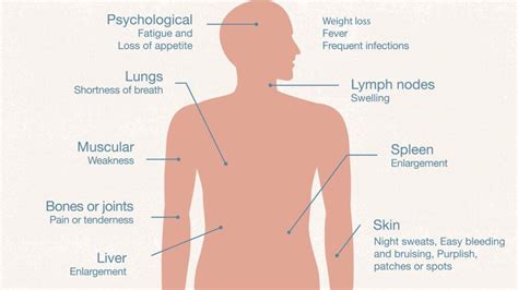 Signs And Symptoms Of Acute Lymphoblastic Leukemia Ask The Nurse Expert