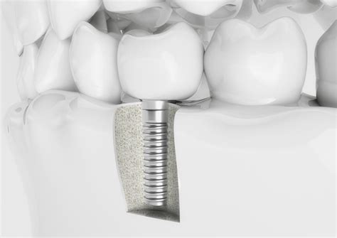 Stuart J Froum Dds Stuart J Froum Dds Offers Dental Implants To