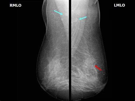 Atlas Of Breast Cancer Early Detection