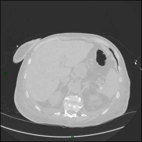 Filelung Abscess Its Drainage And Resolution Radiopaedia 82375