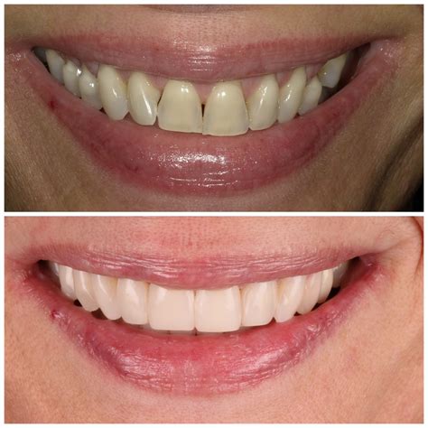 Bioclear® Composite Restorations Massapequa Ny Dr Douglas Saggio