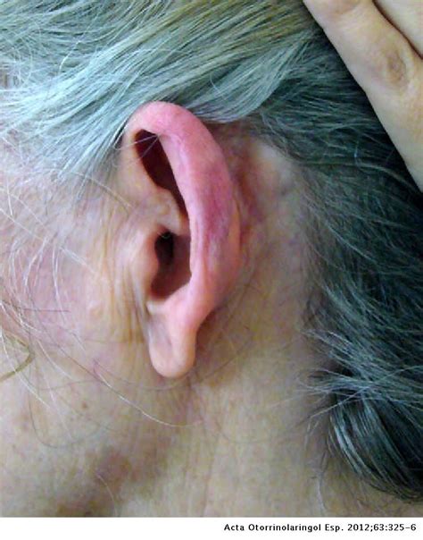 Retroauricular Arteriovenous Fistula Acta Otorrinolaringológica Española