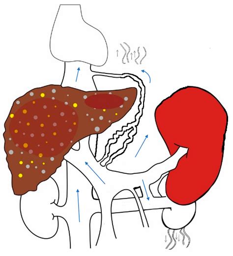 Portal Hemodynamics After Living Donor Liver Transplantation Encyclopedia Mdpi