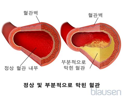 Image정상 혈관 및 부분적으로 막힌 혈관 Msd 매뉴얼 일반인용
