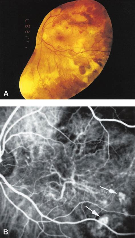 Type Ii Lesion This 61 Year Old Woman Had A Subfoveal Occult