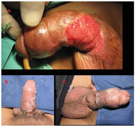 Split Penis Modification