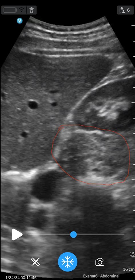 How To Measure Liver On Ultrasound Craniocaudal Length Transverse Volume And Ap Measurements