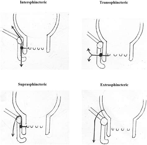 Parks Classification Of Anal Fistulae Download Scientific Diagram