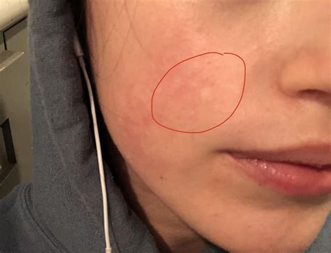 White Spots On Skin Getting Bigger At Robert Towner Blog