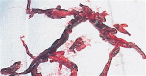 Lv Thrombus Treatment Uptodate