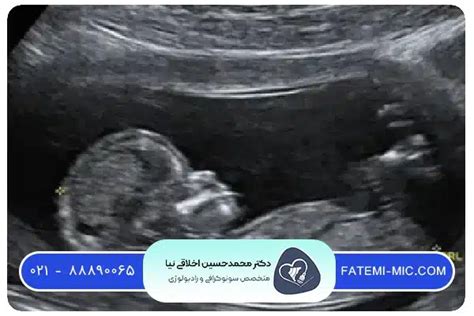 تفاوت جنین دختر و پسر در سونوگرافی هفته 12 دکتر محمدحسین اخلاقی نیا