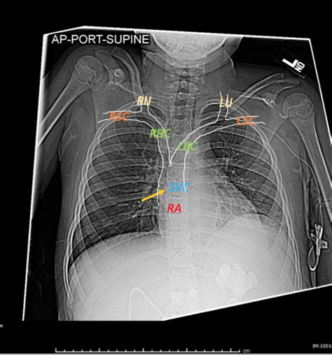 Picc In Innominate Vein