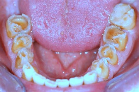 Our Results General Dentistry In Hamden Ct Serene Smiles Of Hamden
