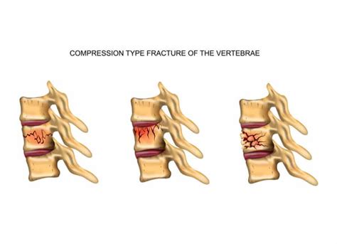 L3 Spine 3rd Lumbar Vertebra Anatomy Injuries And More