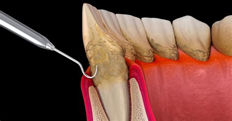 Parodontite Una Nuova Classificazione Dental Evolution School