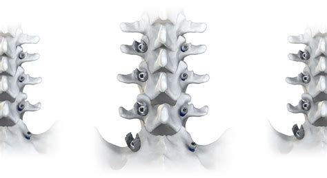 Accelus Debuts Linesider Modular Cortical System