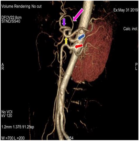 Celiac Artery Angiogram
