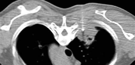 Percutaneous Marker Placement Under Ct Guidance A Prior To Treatment
