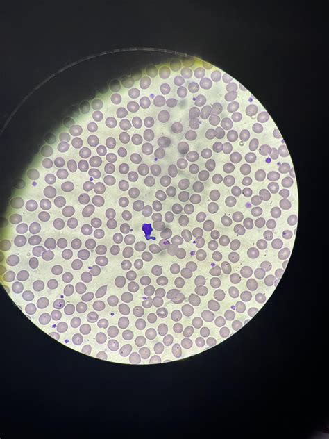 Reactive Lymph R Medlabprofessionals